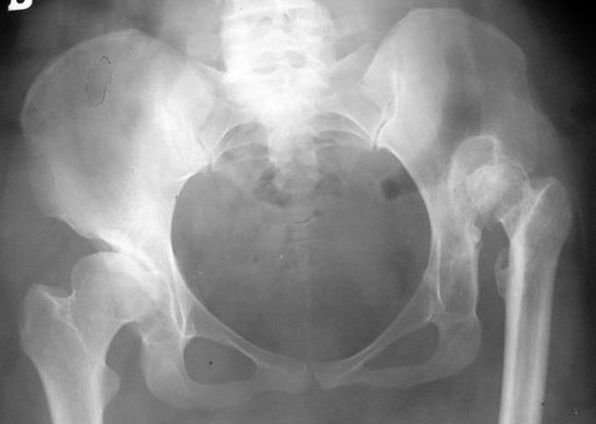 Luxaţie congenitală